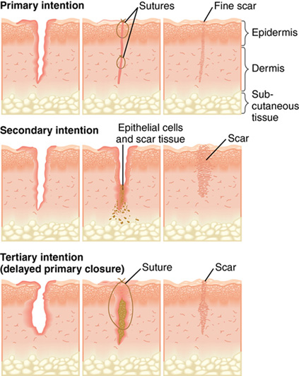 Acute & Chronic Wounds : Current Management Concepts