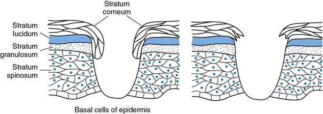 Acute & Chronic Wounds : Current Management Concepts