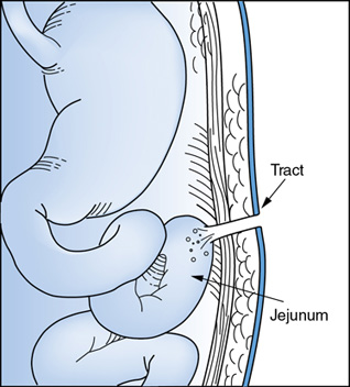 Acute & Chronic Wounds : Current Management Concepts