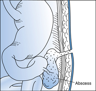 Acute & Chronic Wounds : Current Management Concepts