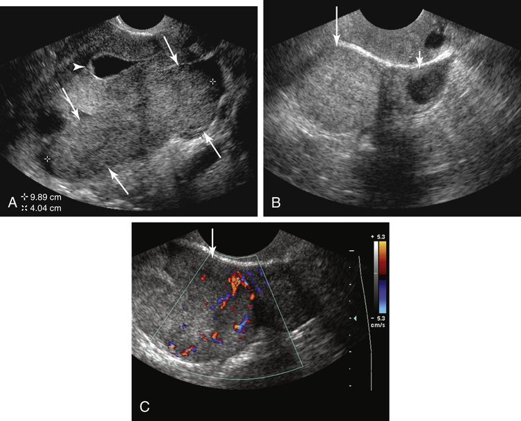 Ultrasound