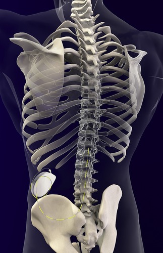 Intraspinal Access and Medication Administration