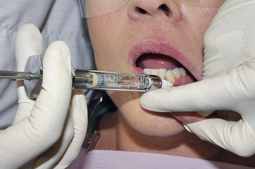 Local Anesthesia for the Dental Hygienist