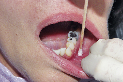 Local Anesthesia for the Dental Hygienist