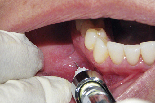 Local Anesthesia for the Dental Hygienist