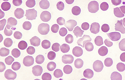 Dacie and Lewis Practical Haematology