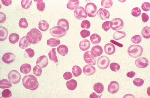 Dacie and Lewis Practical Haematology