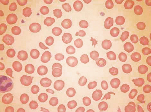 Dacie and Lewis Practical Haematology