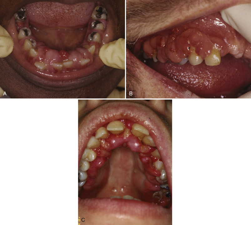 Oral pathology