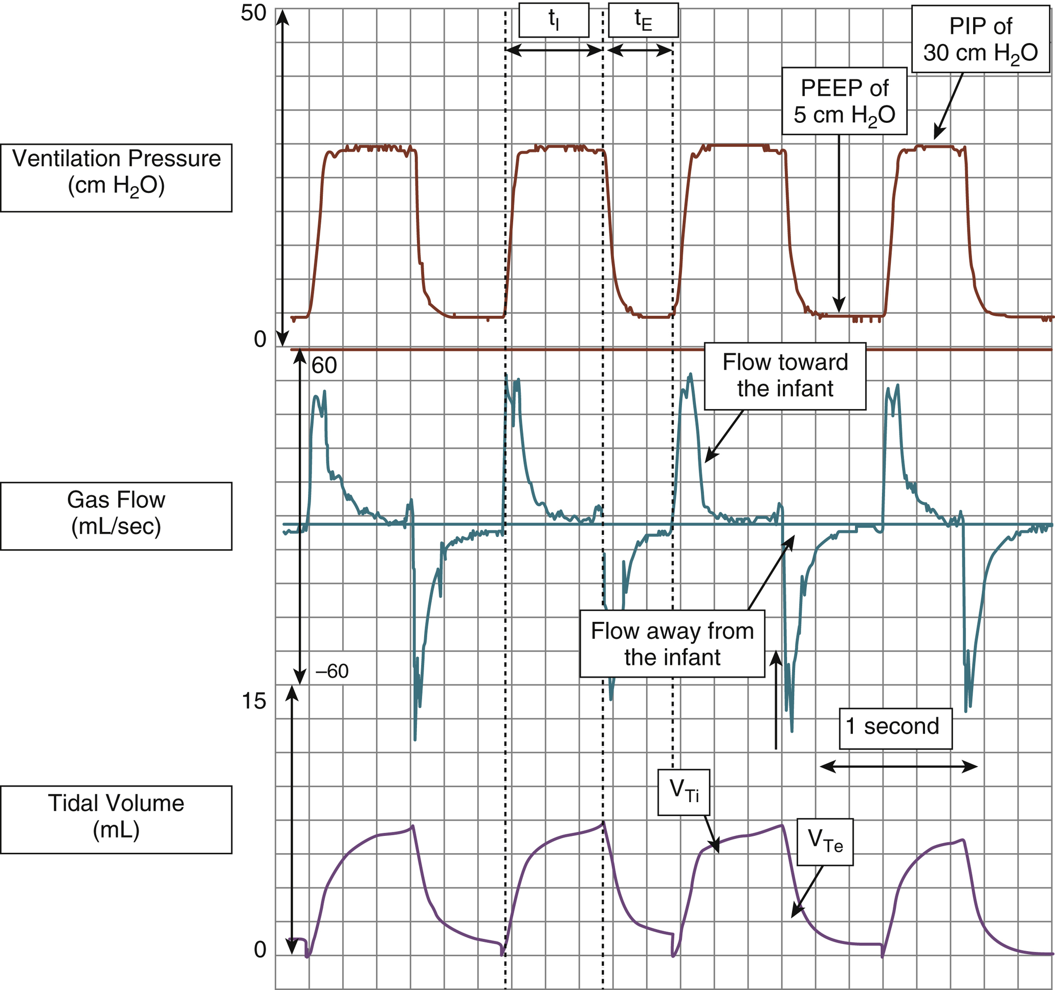 Assisted Ventilation of the Neonate