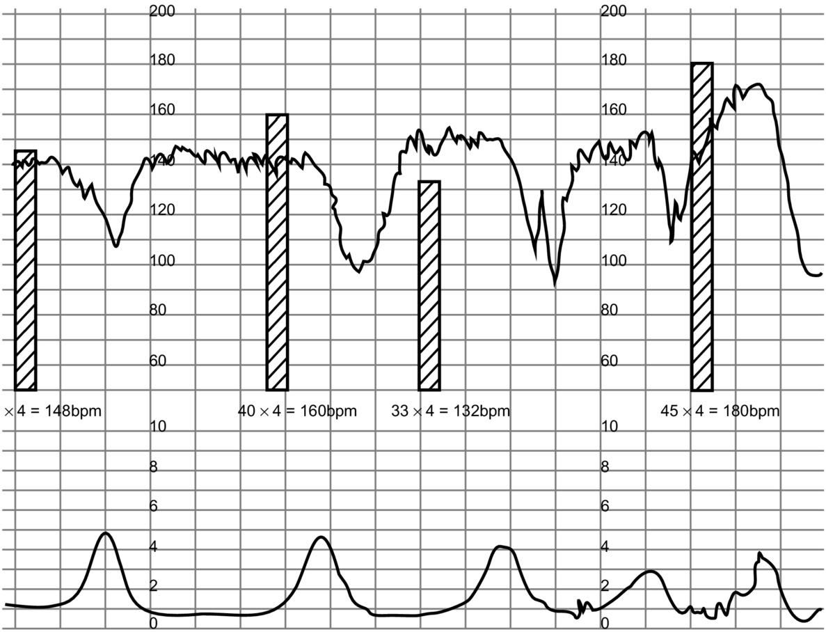 Fetal Monitoring in Practice