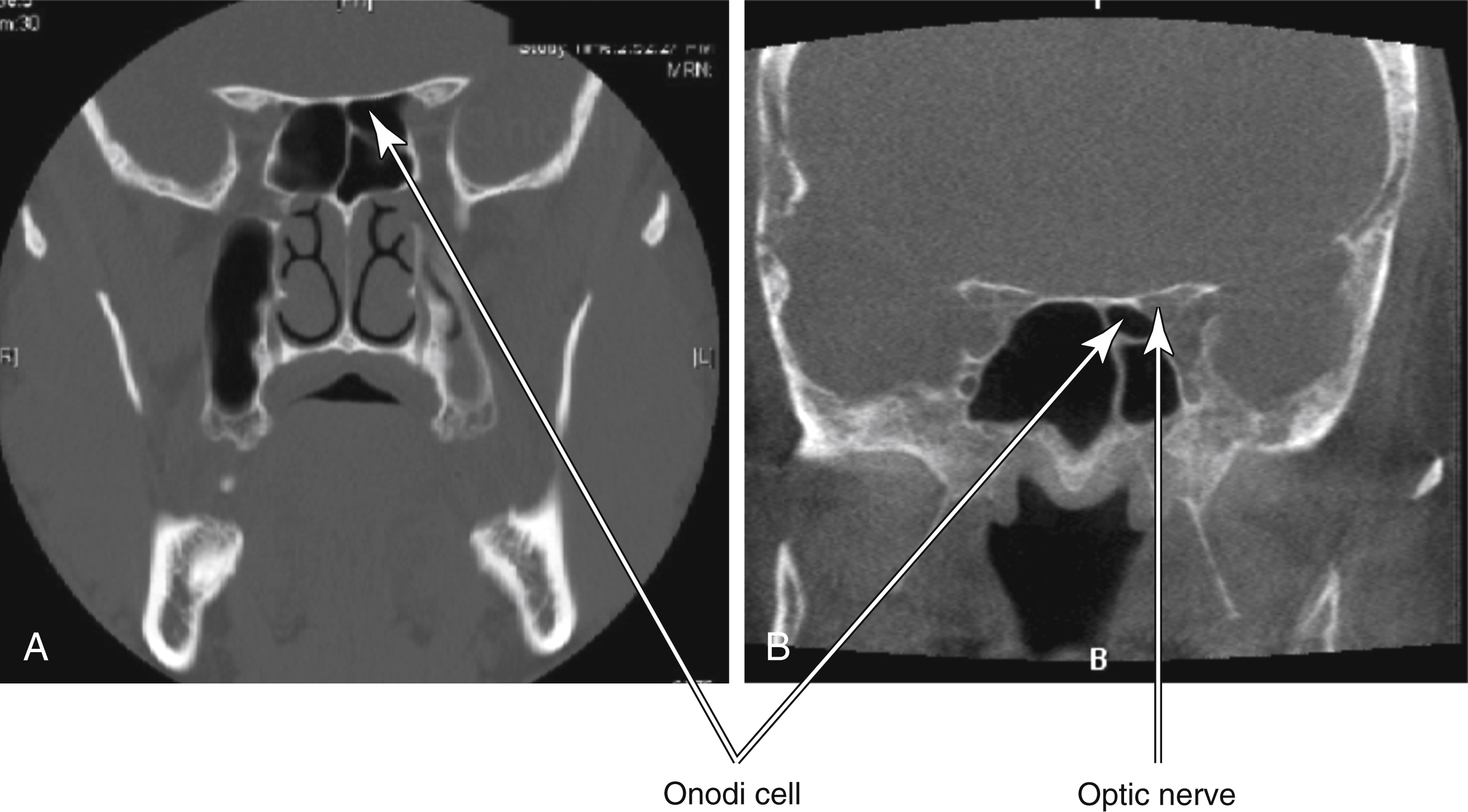 Atlas of Endoscopic Sinus and Skull Base Surgery