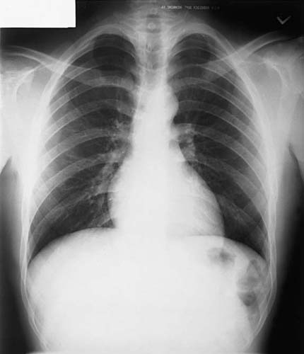 Radiographic Imaging and Exposure