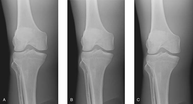 Radiographic Imaging and Exposure