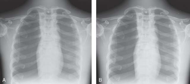 Radiographic Imaging and Exposure