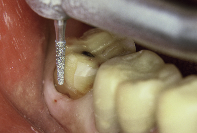 Dental Instruments
