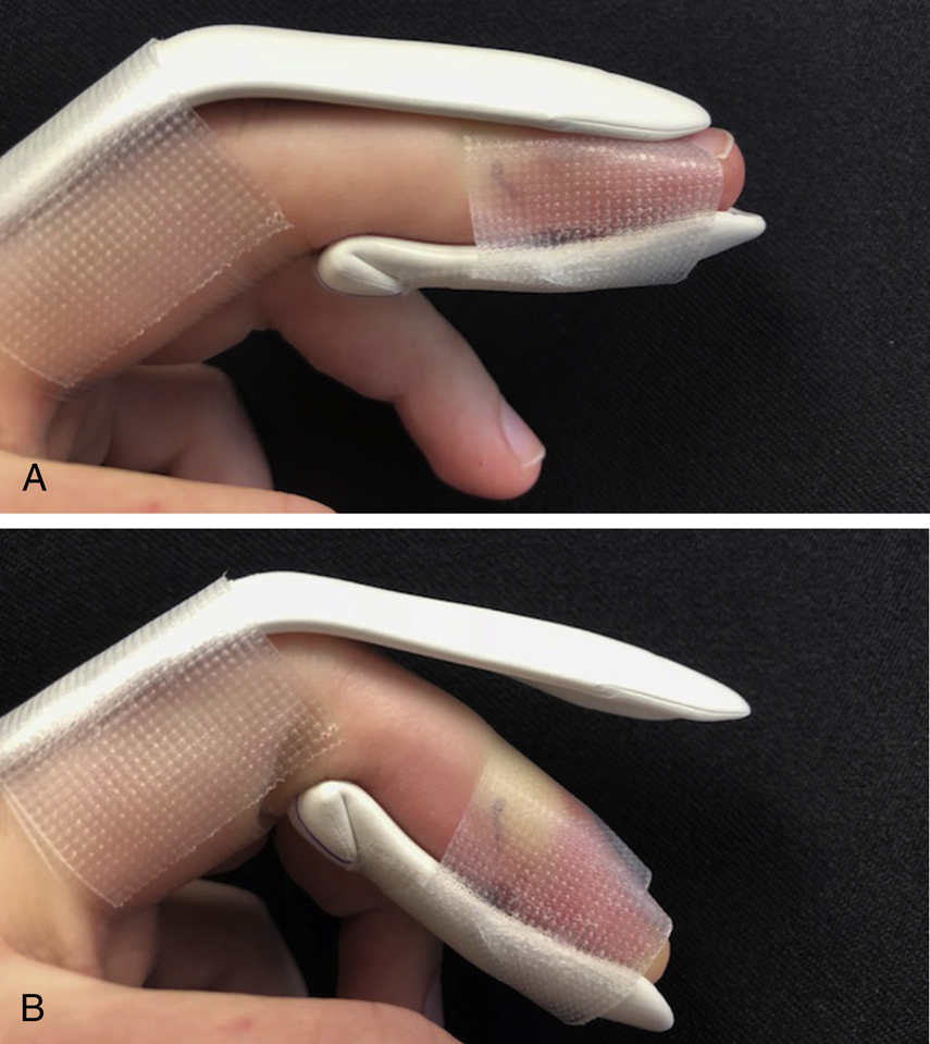 Rehabilitation of the Hand and Upper Extremity