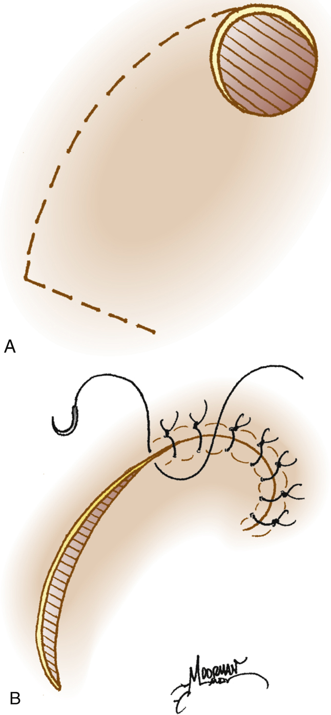 Rehabilitation of the Hand and Upper Extremity
