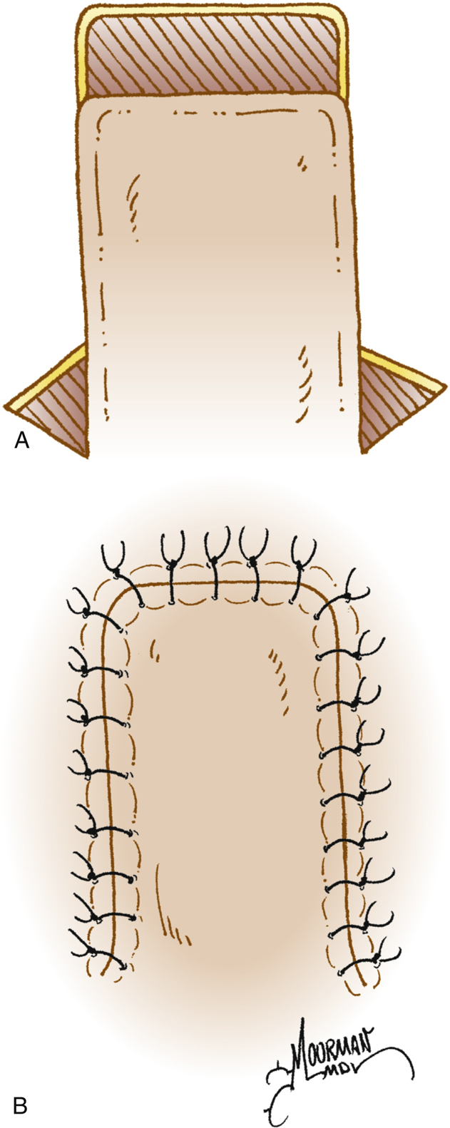 Rehabilitation of the Hand and Upper Extremity