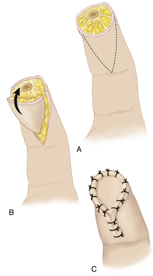 Rehabilitation of the Hand and Upper Extremity