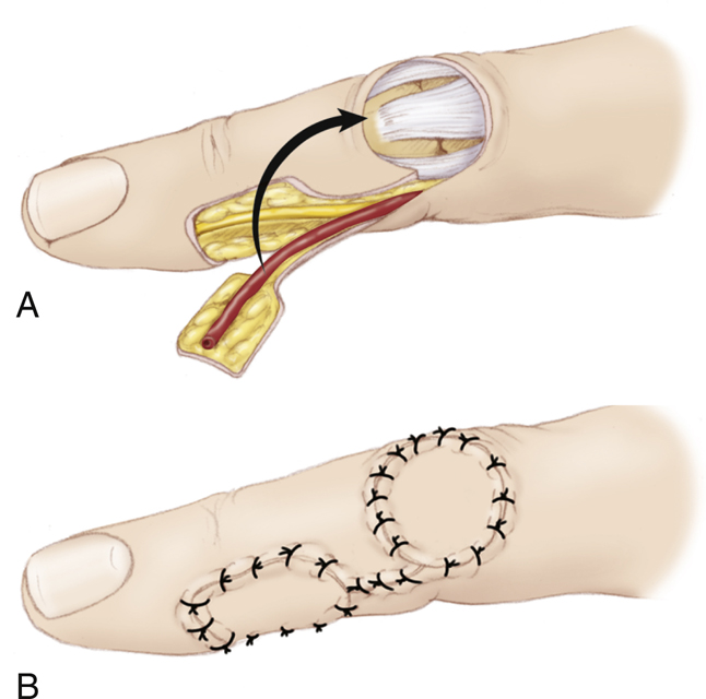 Rehabilitation of the Hand and Upper Extremity