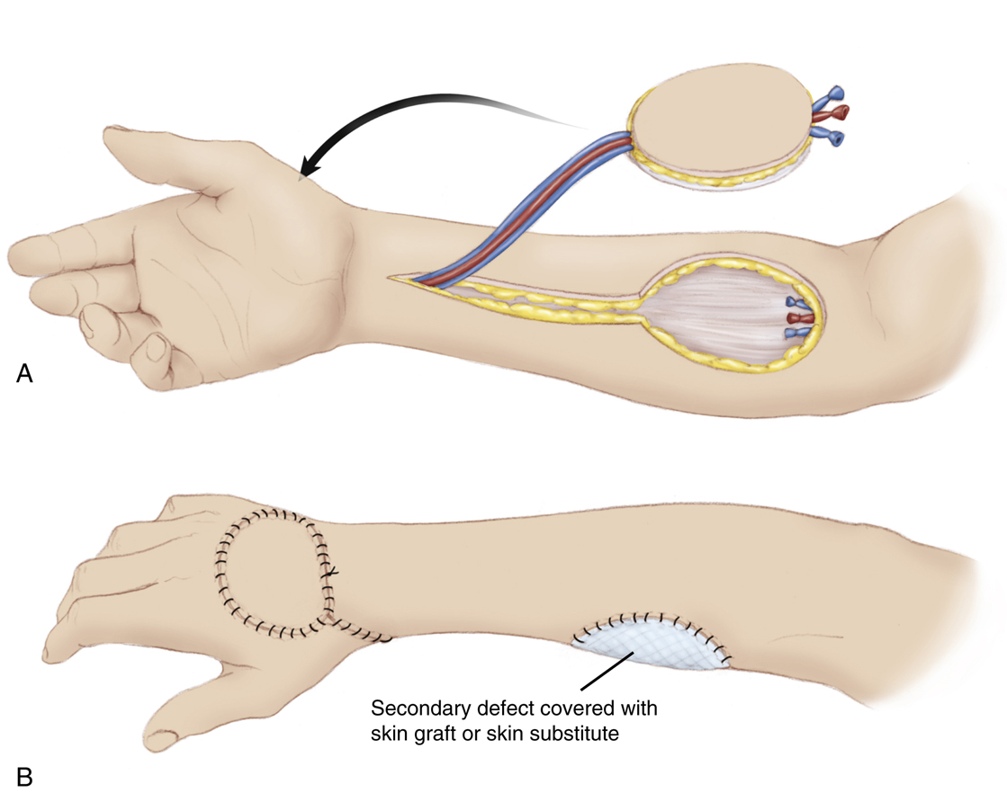 Rehabilitation of the Hand and Upper Extremity