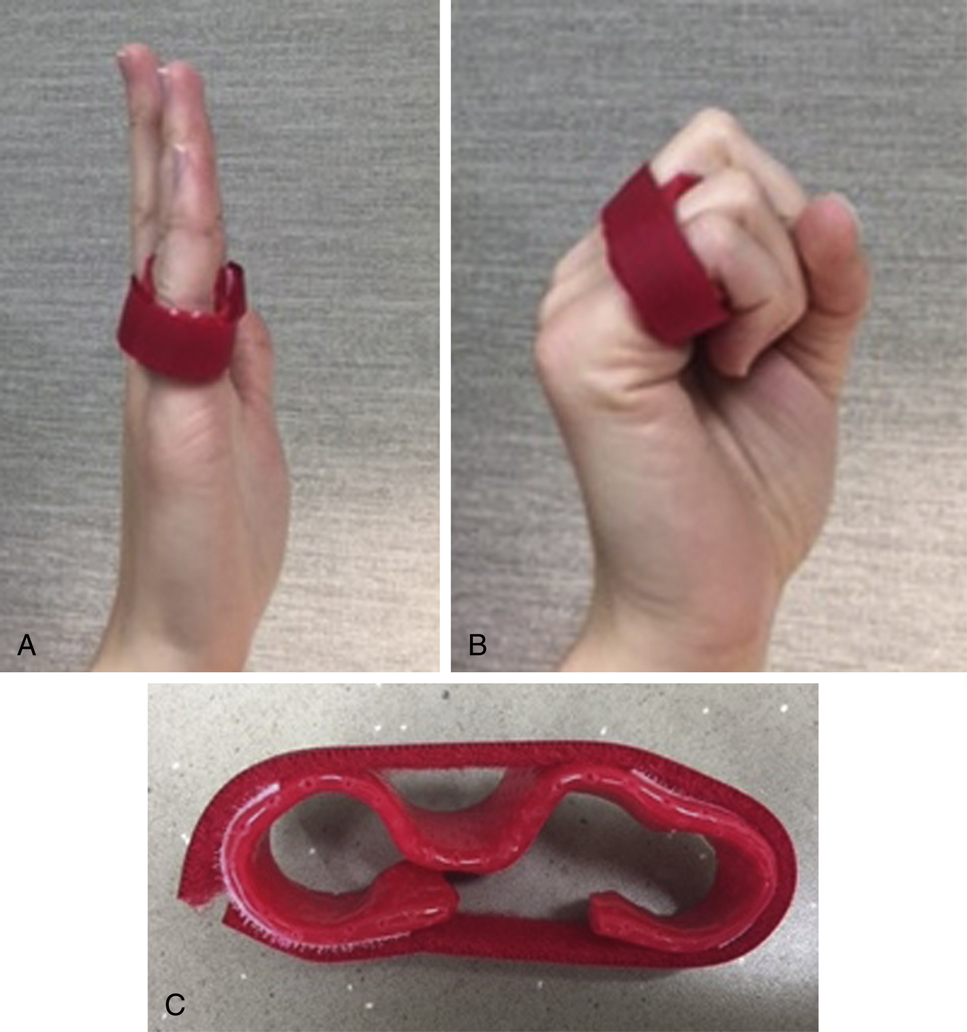 Rehabilitation of the Hand and Upper Extremity