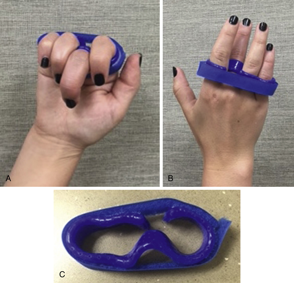 Rehabilitation of the Hand and Upper Extremity