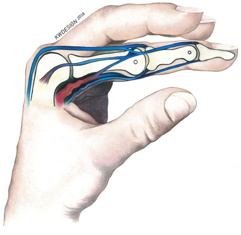 Rehabilitation of the Hand and Upper Extremity