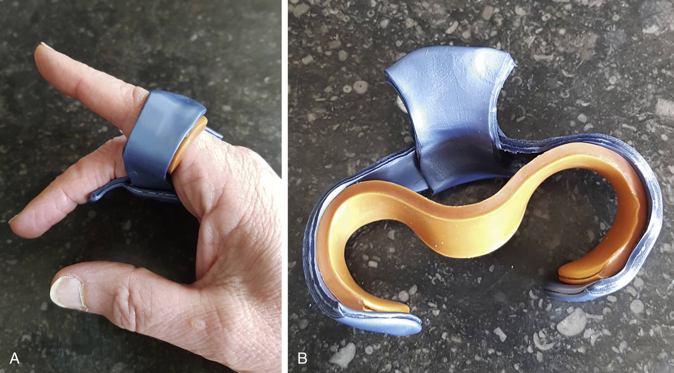Rehabilitation of the Hand and Upper Extremity