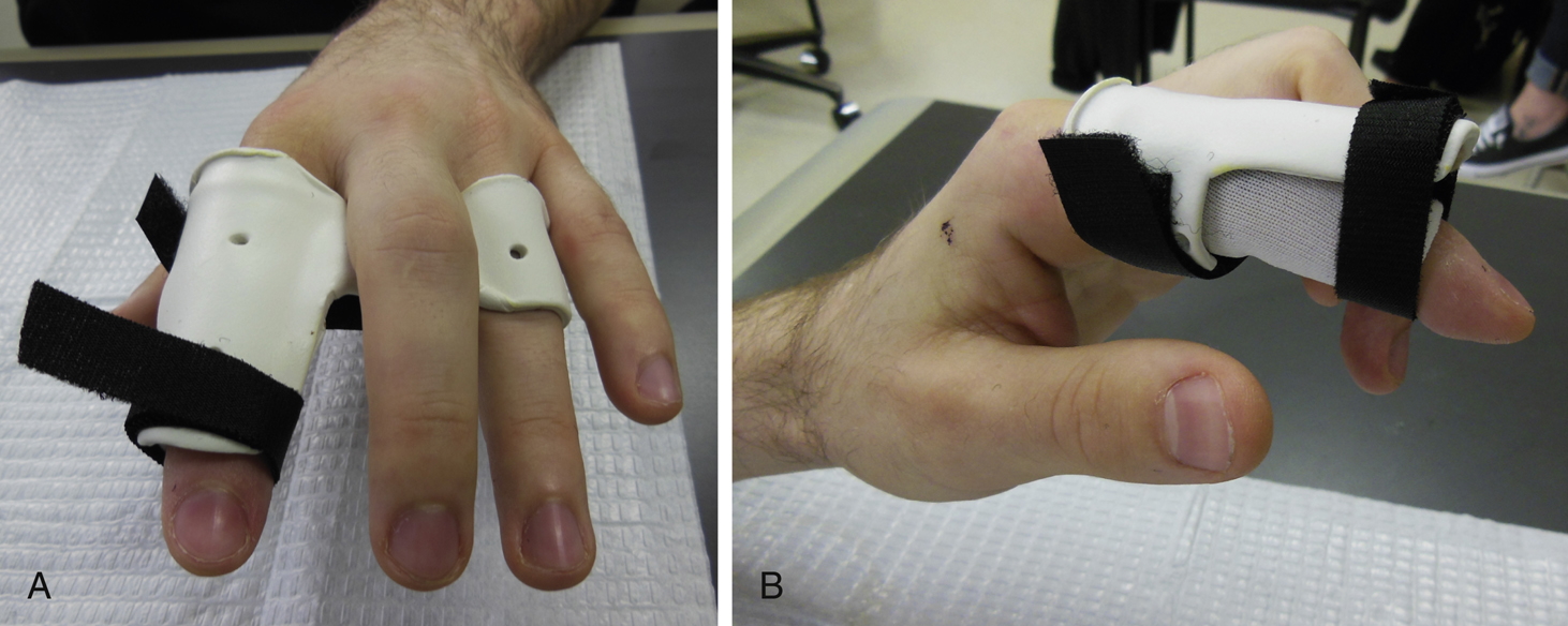 Rehabilitation of the Hand and Upper Extremity