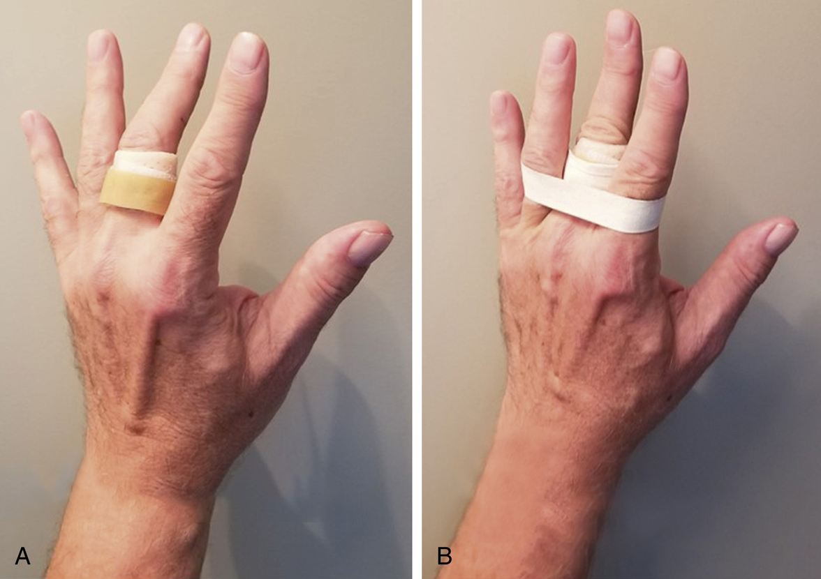 Rehabilitation of the Hand and Upper Extremity