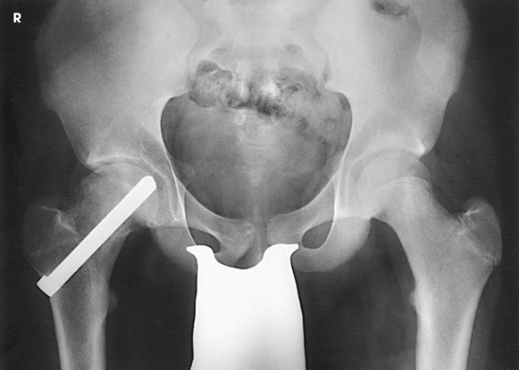 Pelvis and Hip