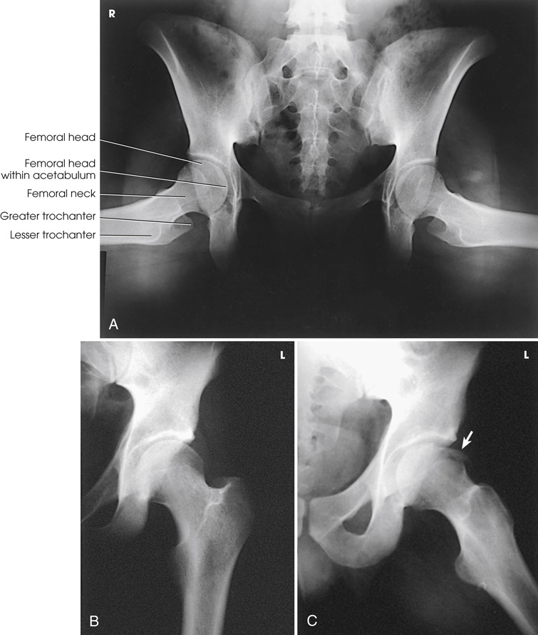 Pelvis and Hip