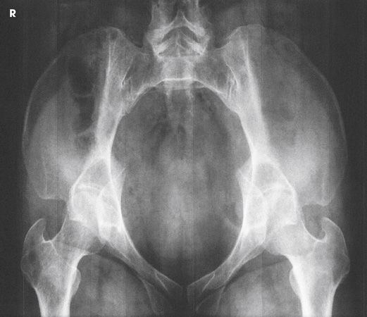 Pelvis and Hip