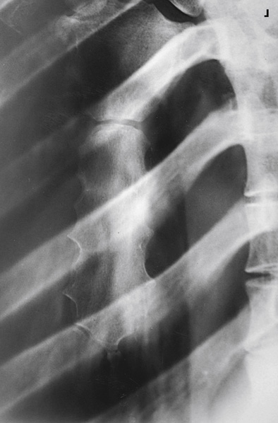 Bony Thorax
