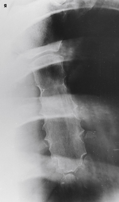 Bony Thorax
