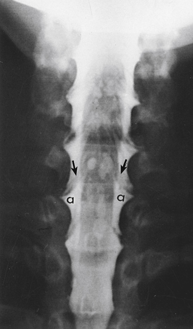 Myelography and Other Central Nervous System Imaging