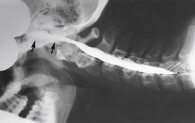 Myelography and Other Central Nervous System Imaging