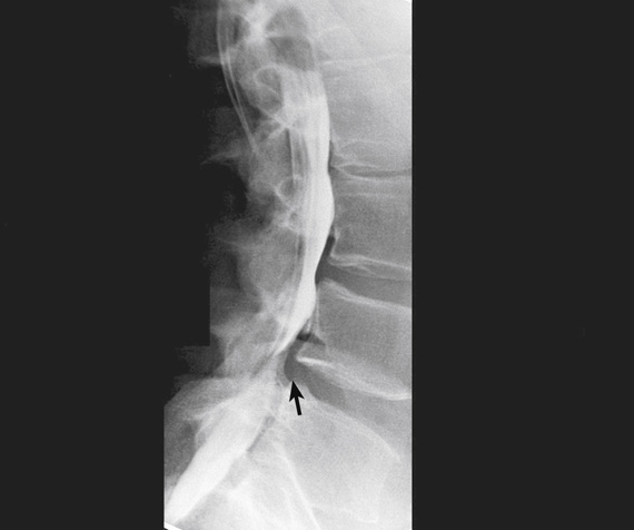 Myelography and Other Central Nervous System Imaging