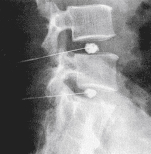 Myelography and Other Central Nervous System Imaging