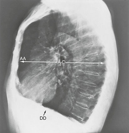 Care of the Patient With a Respiratory Disorder
