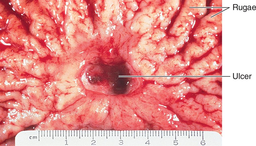 41: Alterations of Digestive Function