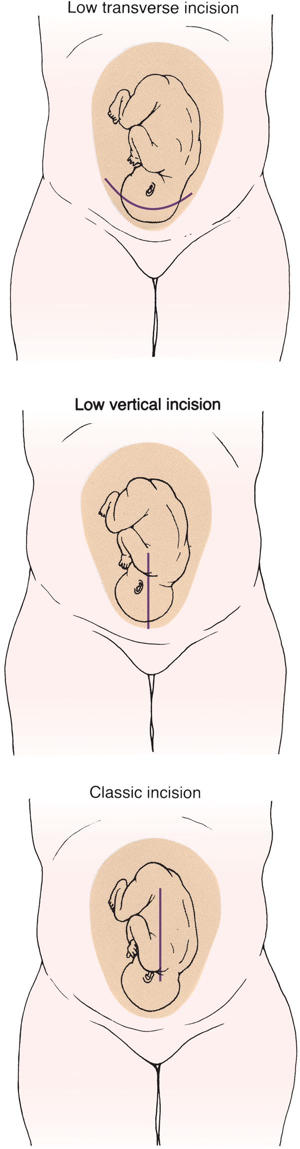 8: Nursing Care of Women with Complications During Labor and Birth