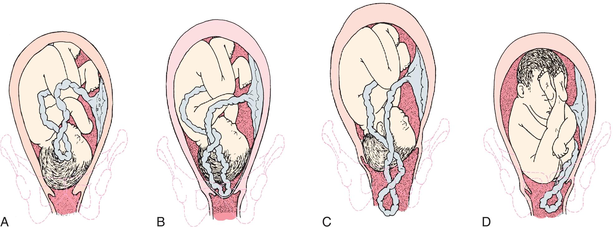 8: Nursing Care of Women with Complications During Labor and Birth