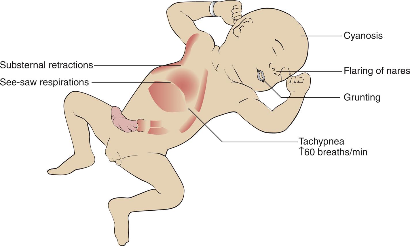 13: Preterm and Postterm Newborns