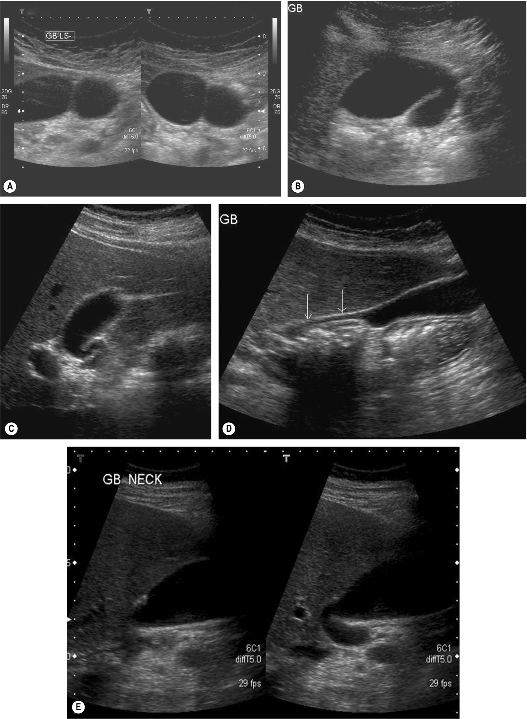 3: Ultrasound of the Gallbladder and Biliary Tree