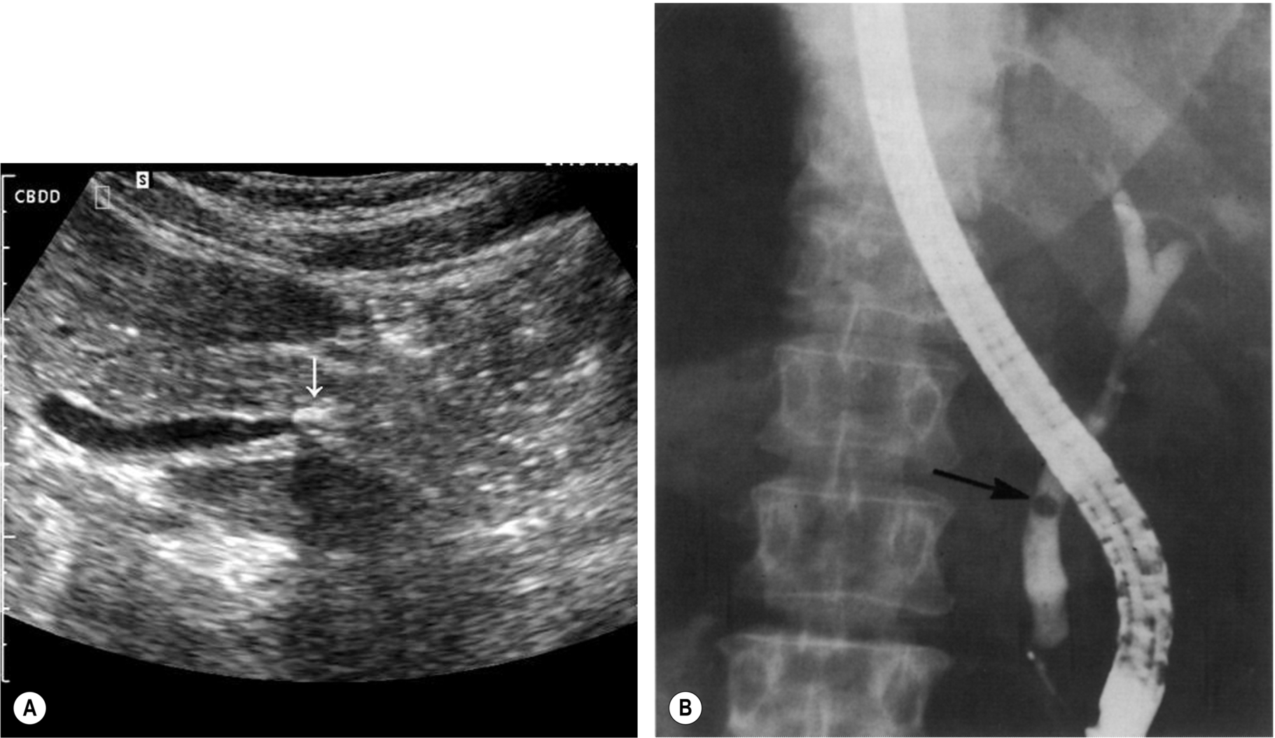 3: Ultrasound of the Gallbladder and Biliary Tree