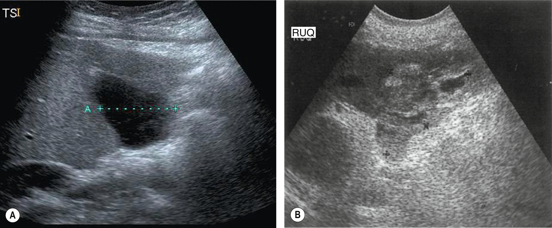 3: Ultrasound of the Gallbladder and Biliary Tree