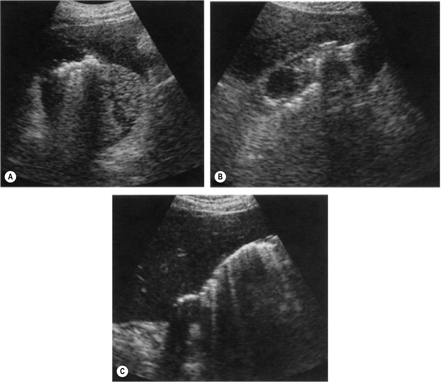 3: Ultrasound of the Gallbladder and Biliary Tree
